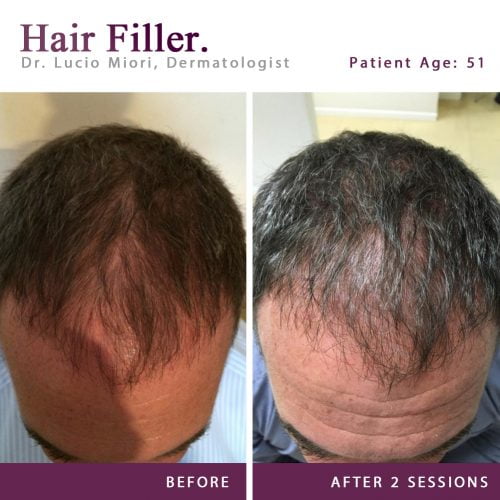 Hair Filler - ProActive SA